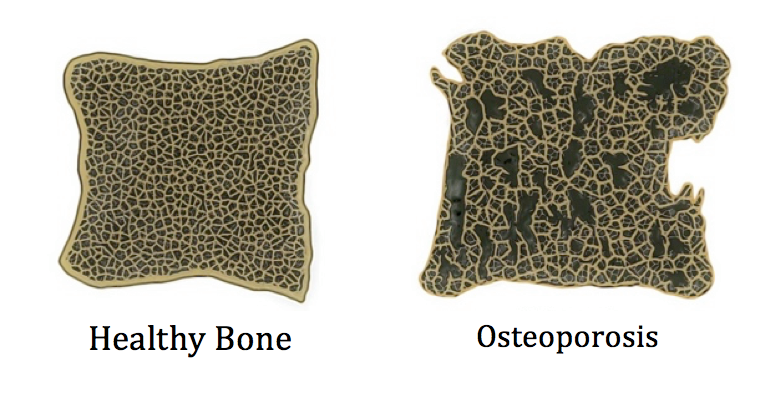 Osteoporosis — The Bone Health Foundation