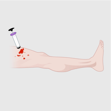 Uterine Tamponade Device — OBSTETRX