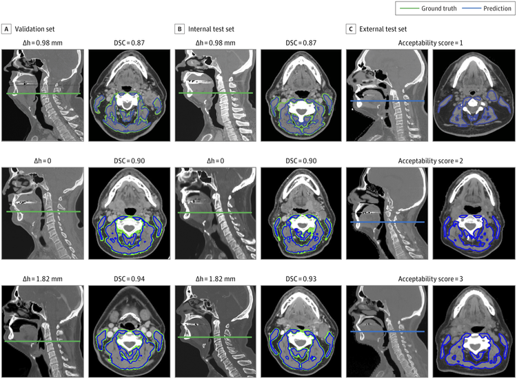 AI assessment of sarcopenia in cancer — AIM - Harvard