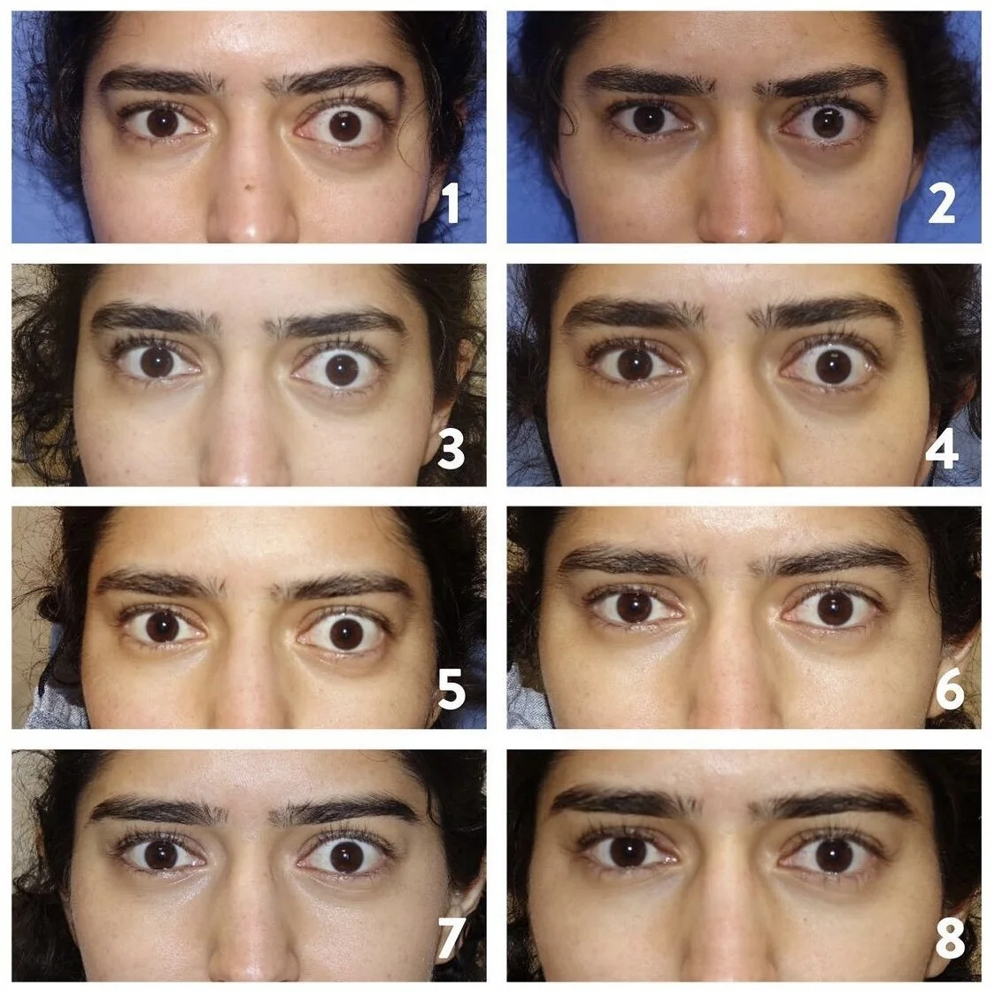 My Journey with Thyroid Eye Disease and Tepezza — Unspoken Nutrition