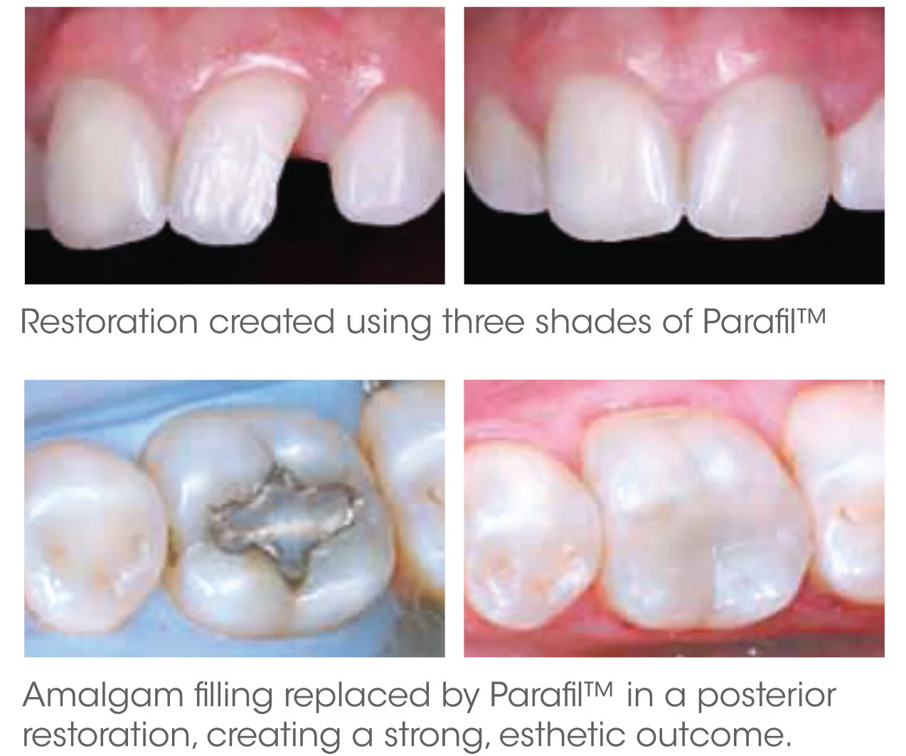 Parafil Composite — Prime Dental Manufacturing