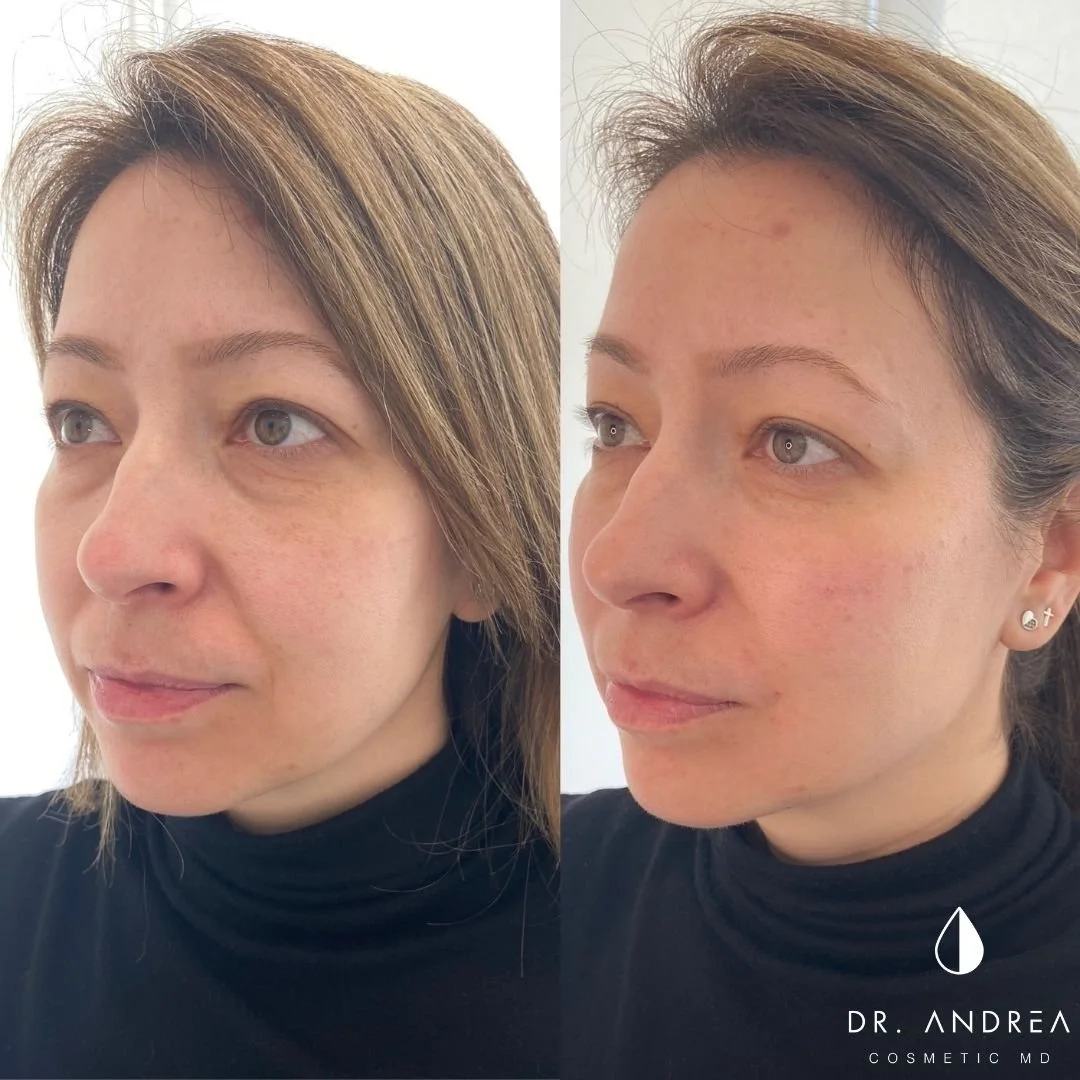 Natural looking results from cosmetic treatments by Dr. Andrea — Dr ...