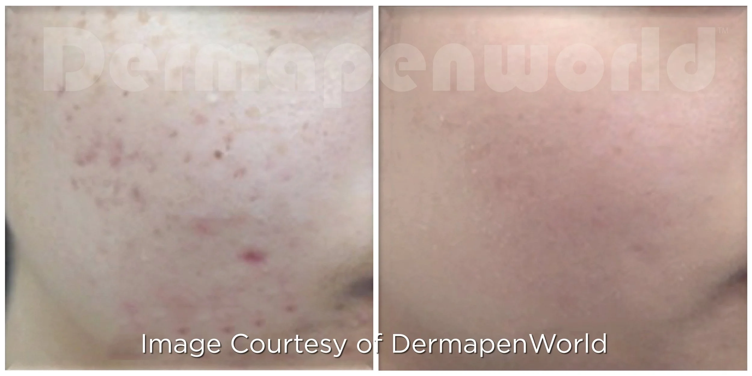 Toronto Pigmented and Vascular Lesions Treatment — Dr. Andrea Cosmetic MD