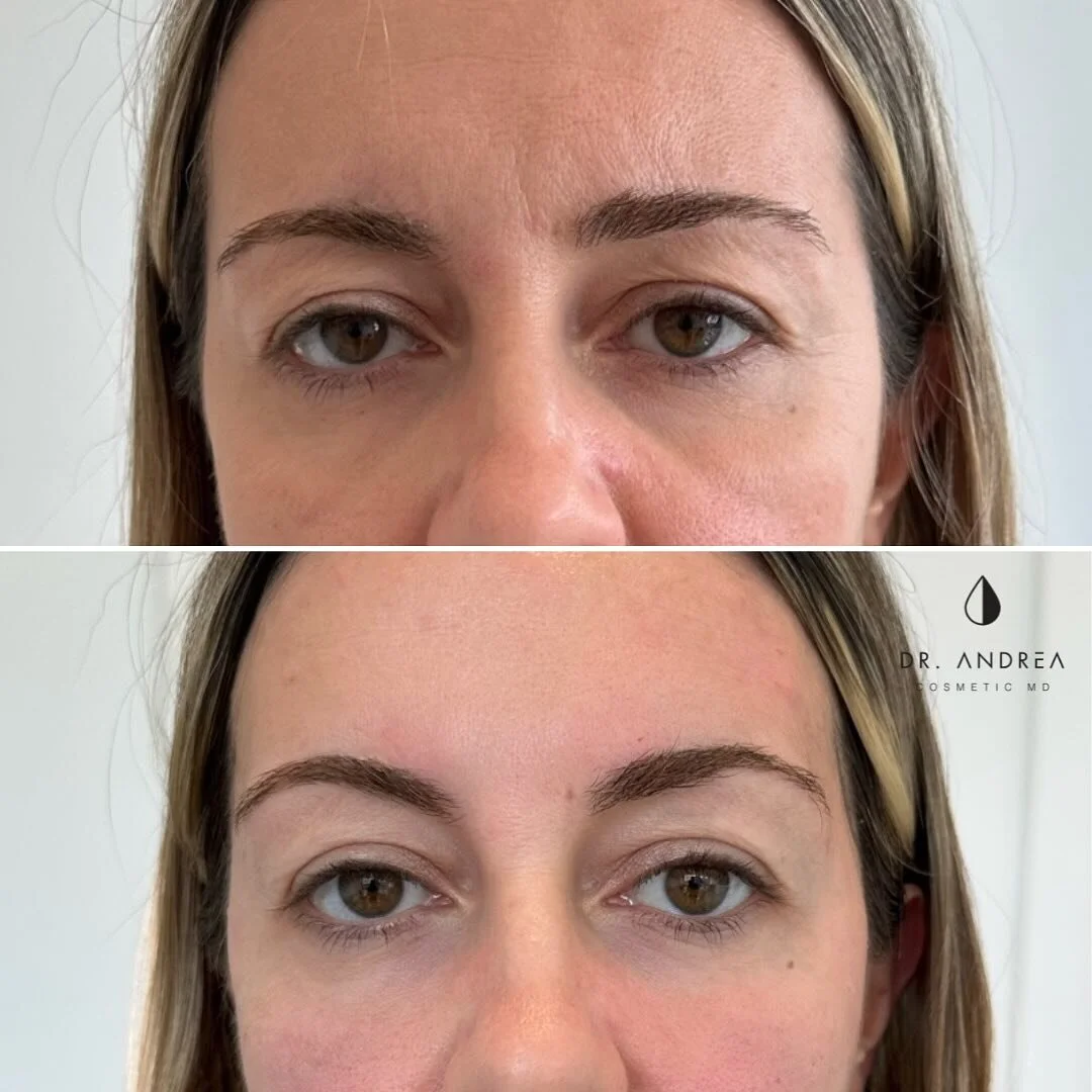 Botox Dermal Fillers Toronto Skin Booster - Dr. Andrea Cosmetic MD