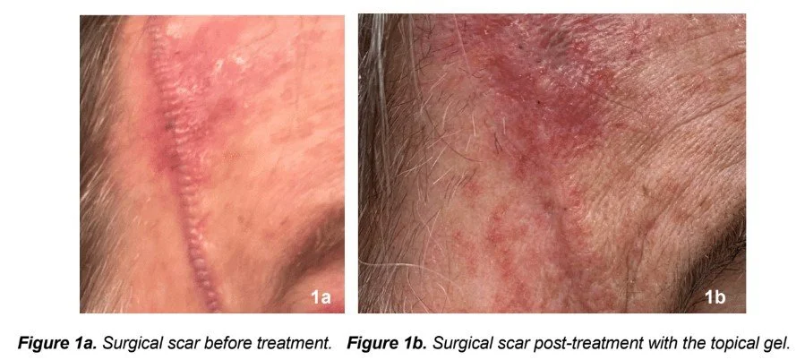 Enhancing Scar Care for Humans and Animals: PCCA’s PracaSil®-Plus Base ...