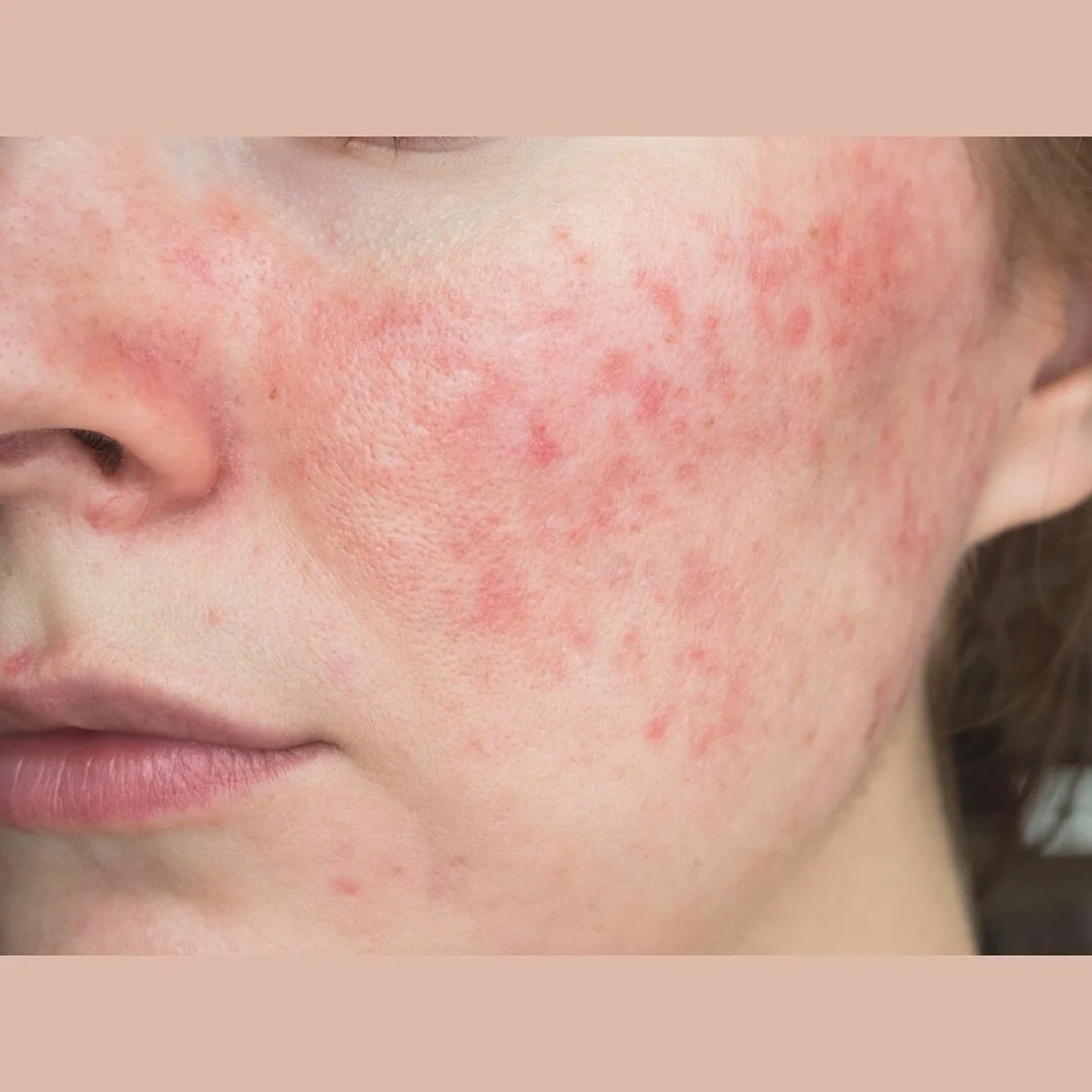 Shop — The Acne And Eczema Clinic