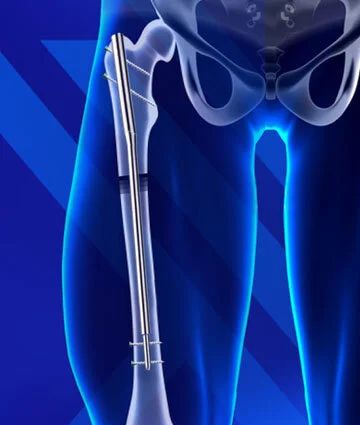 Height Surgery Approach | LimbplastX Institute