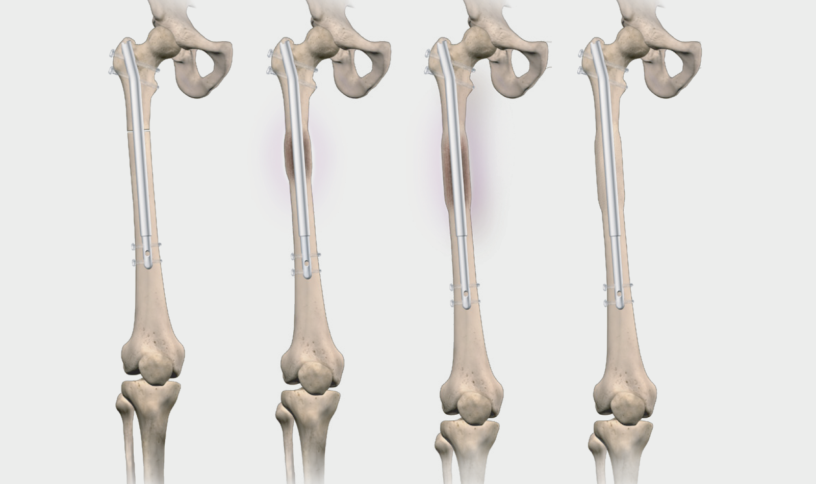 Patient Resources | LimbplastX Institute