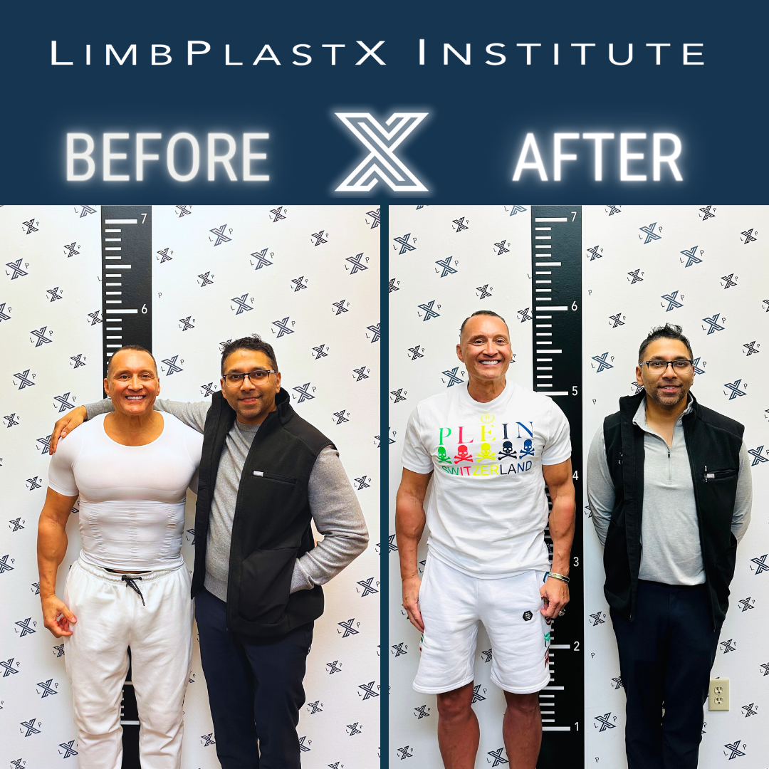 Leg Lengthening Surgery | LimbplastX Institute