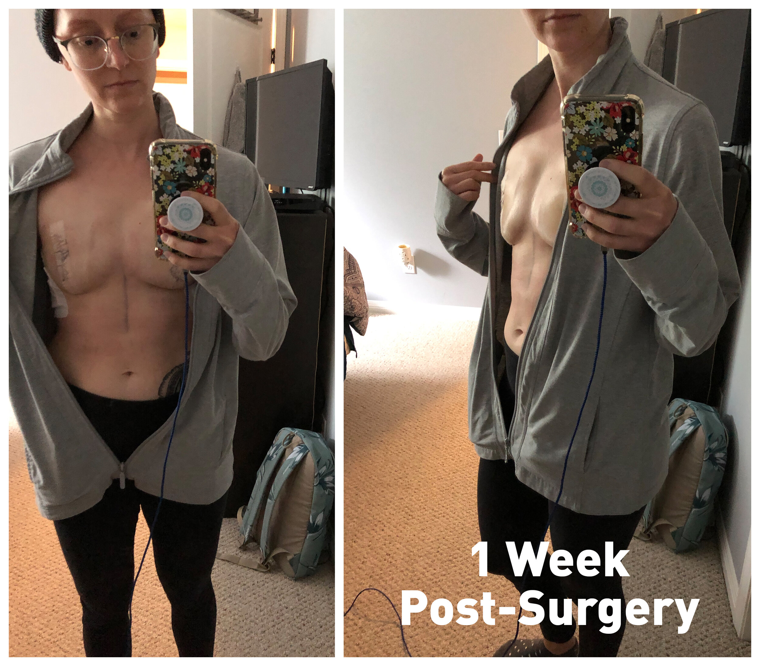 Healing from a Double Mastectomy — She Stays Strong