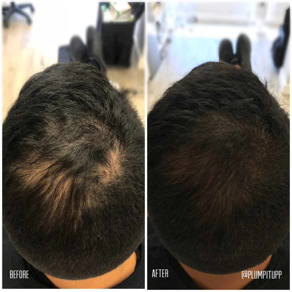 PRP Hair Treatment — Plump It Upp Medi Spa Toronto