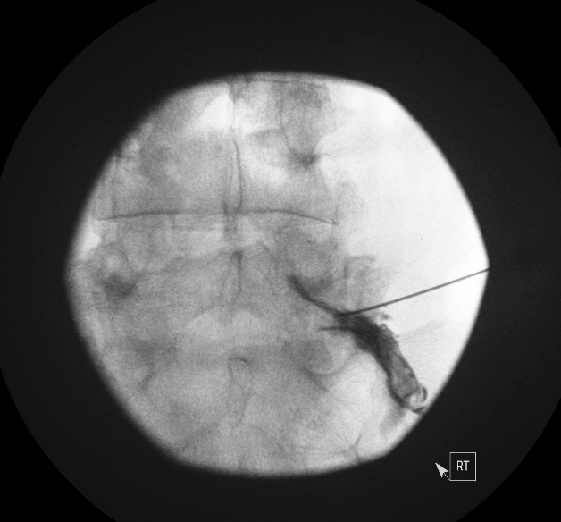 A Quick Reference Guide to Spinal Injections in the Management of Low ...