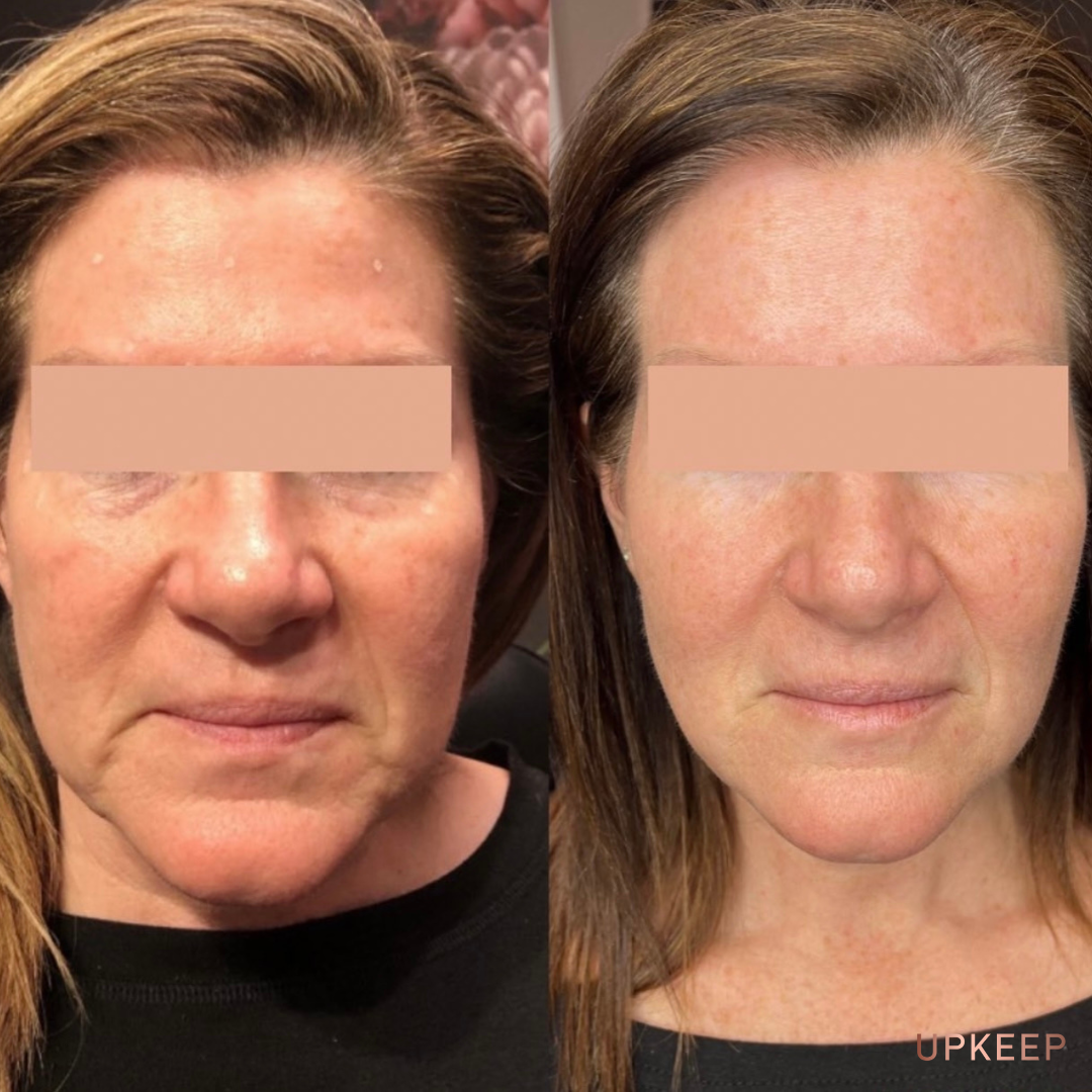 UPKEEP MED SPA — Injections, Aesthetics, Laser and Body Contouring in ... UPKEEP MED SPA — Injections, Aesthetics, Laser and Body Contouring in ...