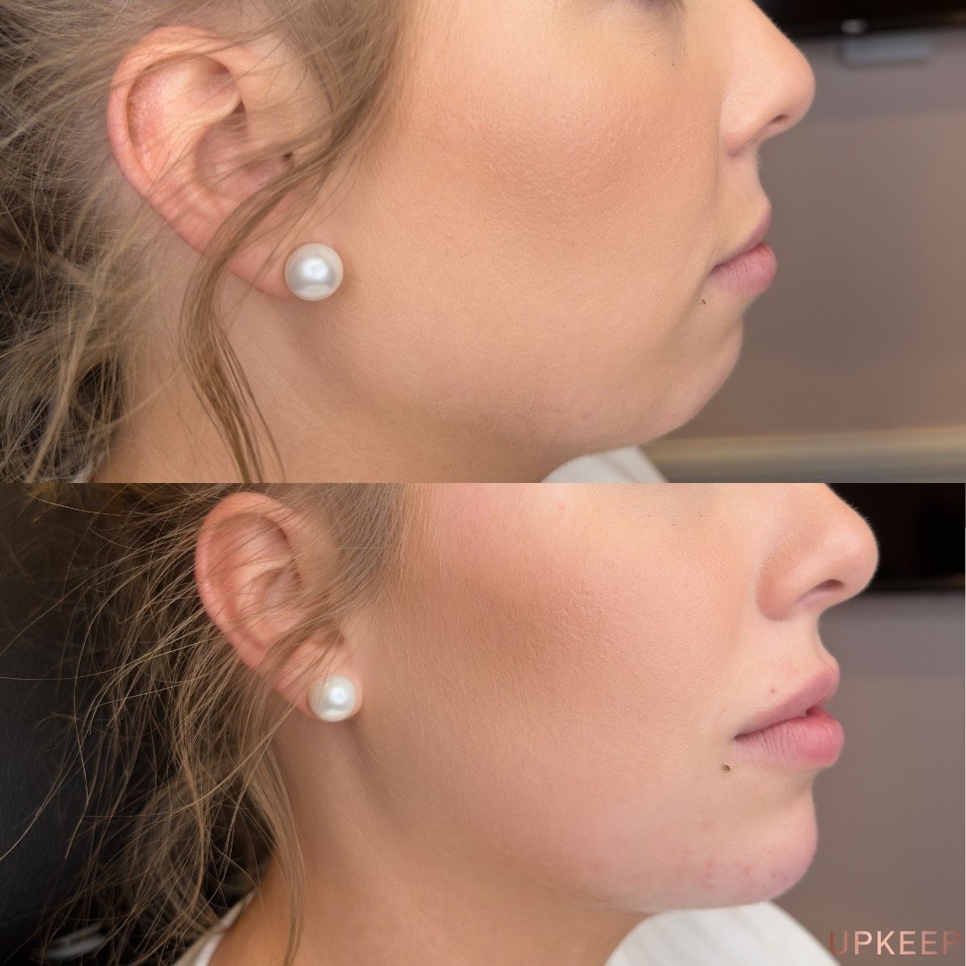 UPKEEP MED SPA — Injections, Aesthetics, Laser and Body Contouring in ...