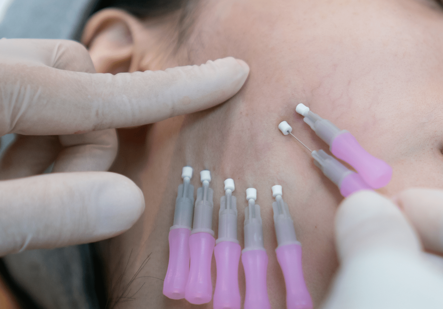 UPKEEP MED SPA — Injections, Aesthetics, Laser and Body Contouring in ...