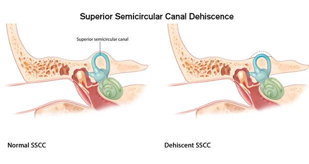 Vestibular Health Superior Semicircular Canal Dehiscence vestibular-health-superior-semicircular-canal-dehiscence