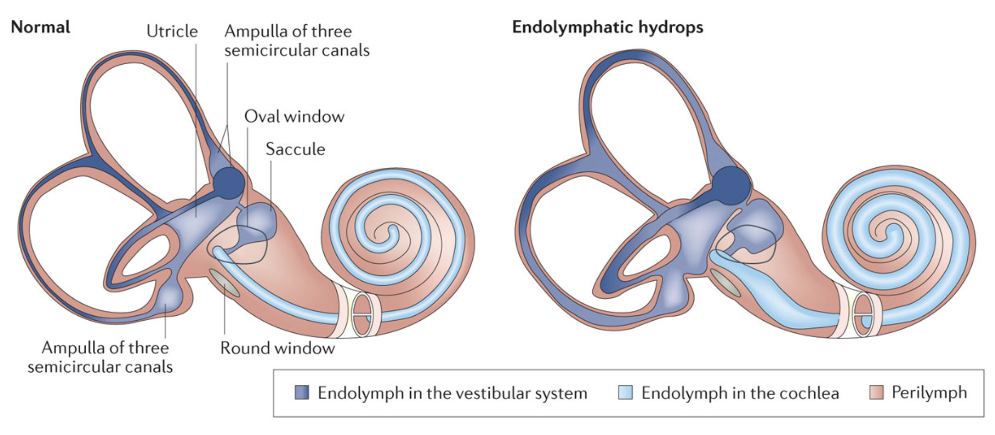 Vestibular Health — Vestibular rehab for Meniere's disease