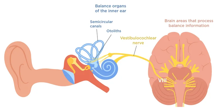 Vestibular Health — Acoustic neuroma - Improving dizziness and balance