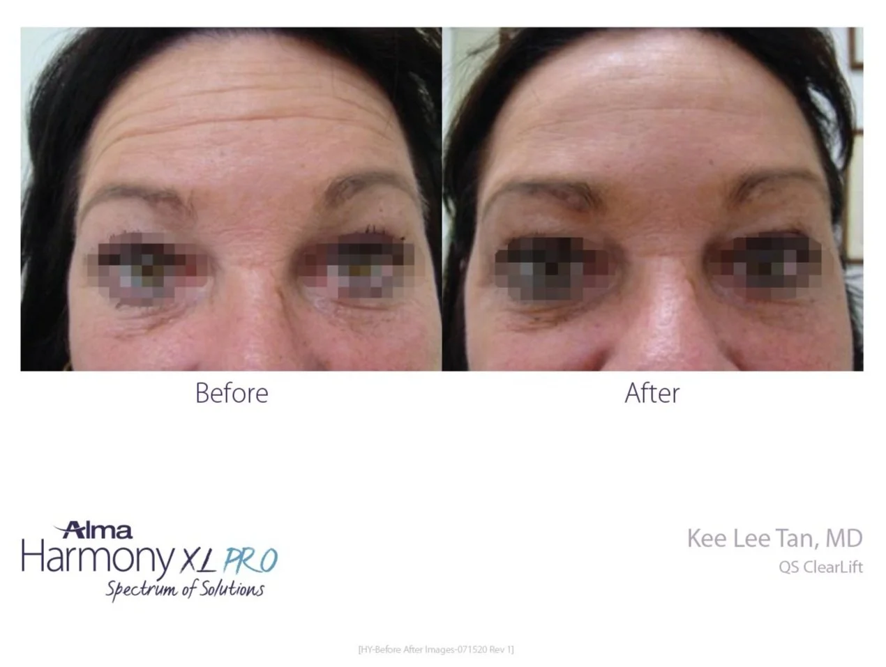 ClearLift Laser — AFFINITY Family Practice