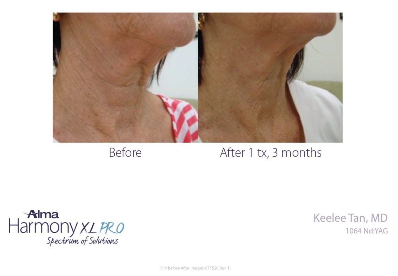 ClearLift Laser — AFFINITY Family Practice