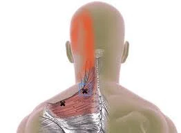 Posterior Trigger Points Neck