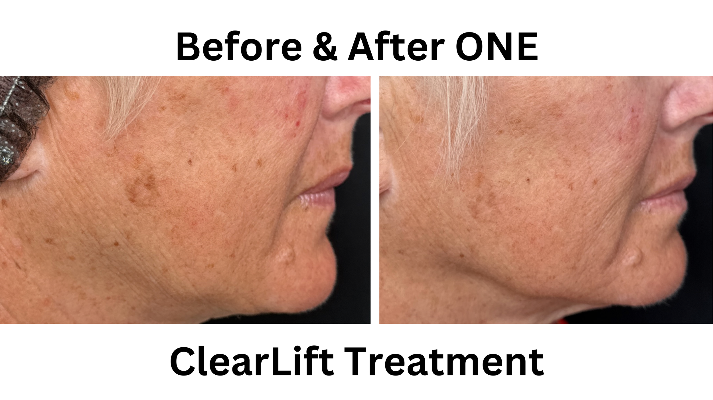 Clear Lift No Downtime Laser Facial — Take it Off PDX