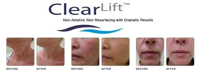 Clear Lift No Downtime Laser Facial — Take it Off PDX