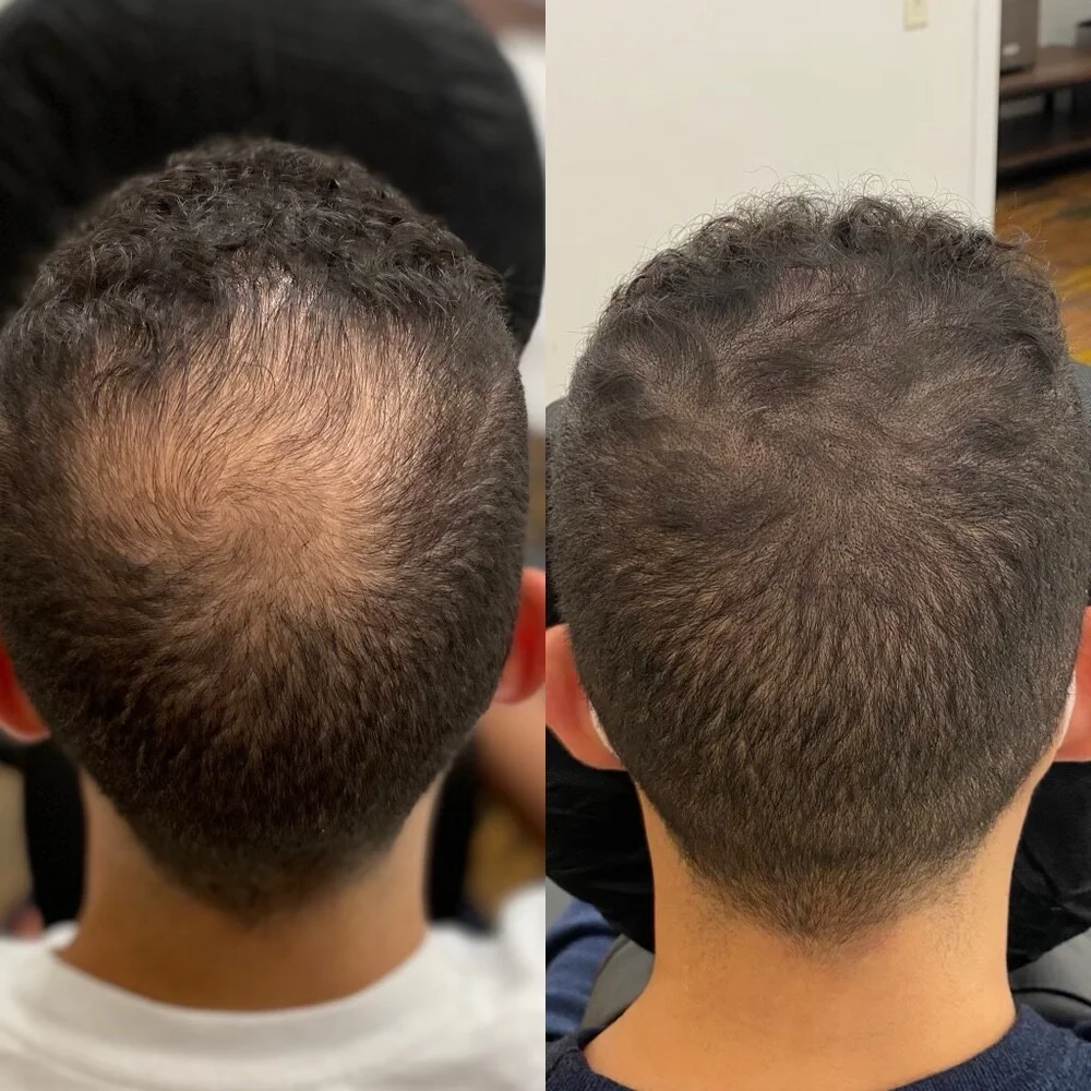Natural Hair Follicle Replication | SMP by Scalp Pro™
