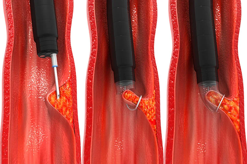 Endoscopic Mucosal Resection EMR — Specialist Centre Ballarat · General ...