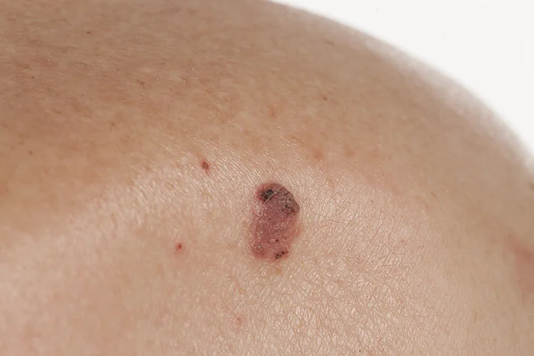 Skin Cancer Surgery Ballarat — Specialist Centre Ballarat · General ...