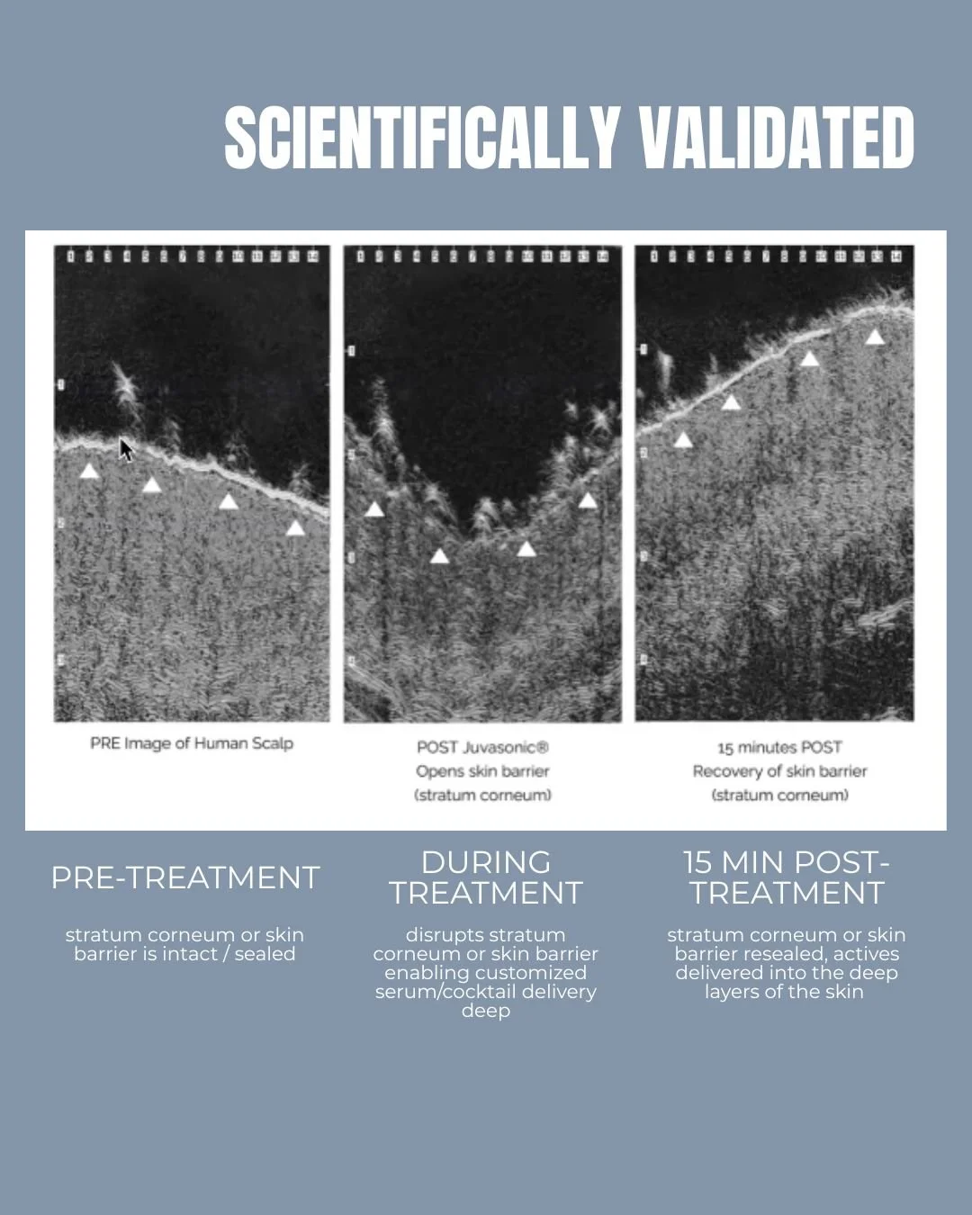 Juvasonic® : A Needleless Skincare Infusion — ici paris skin clinic + spa