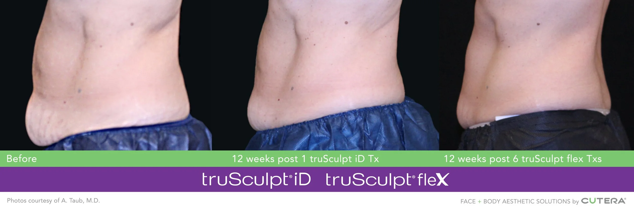 Effective Body Sculpting Treatments to Lose Fat and Build Muscle — ici ...