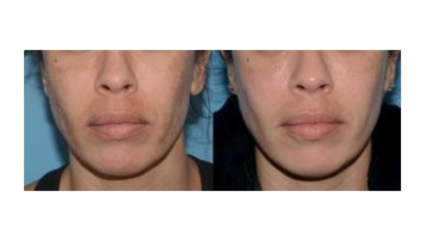 LED Light Therapy - What You Need to Know — ici paris skin clinic + spa