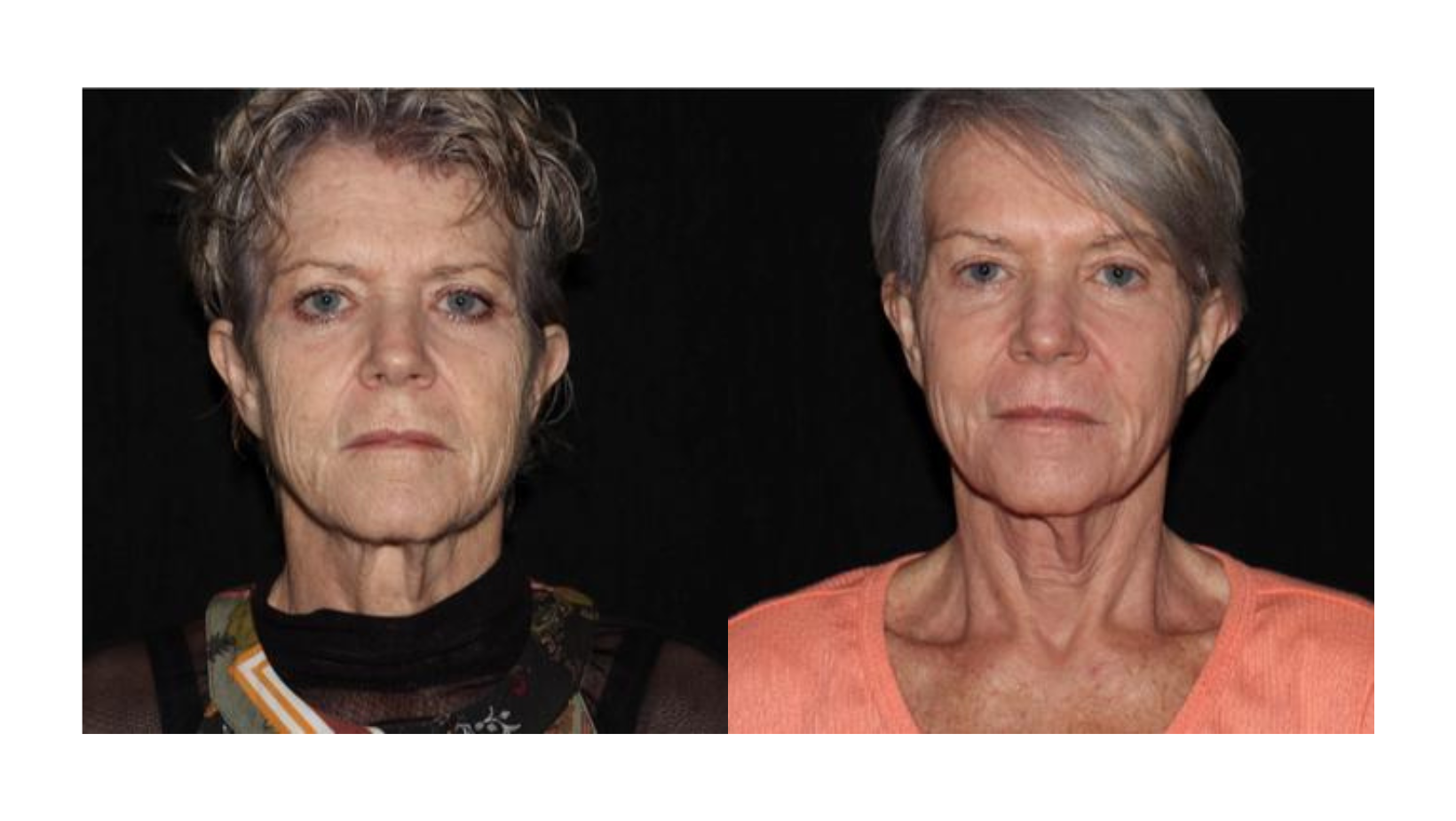 LED Light Therapy - What You Need to Know — ici paris skin clinic + spa