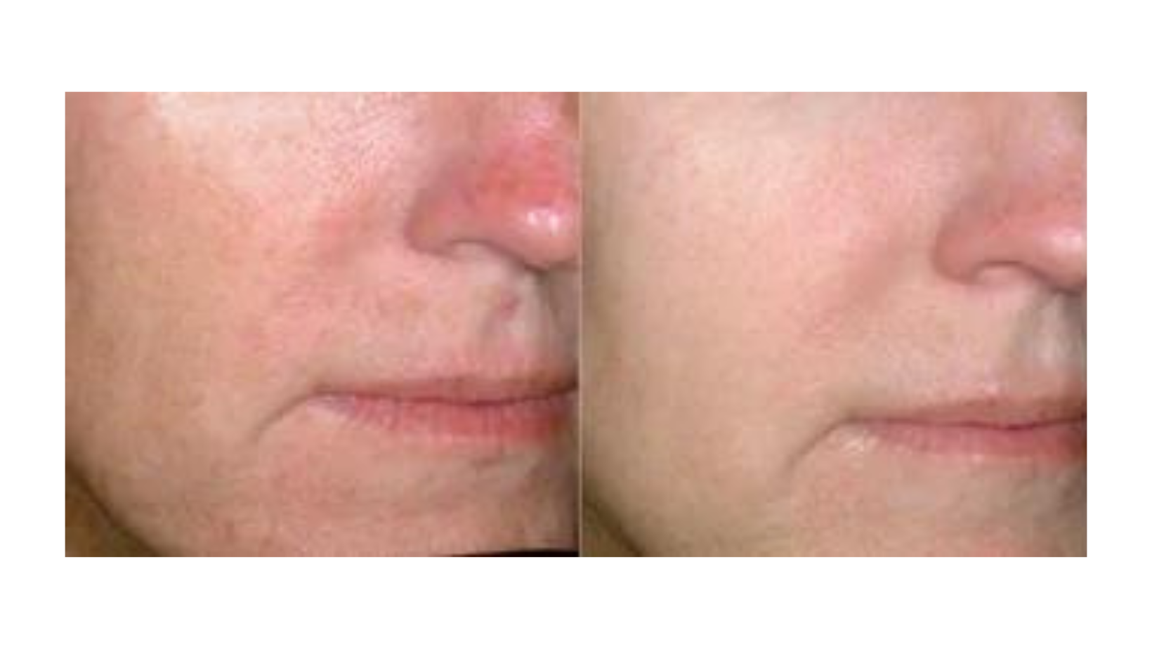 LED Light Therapy - What You Need to Know — ici paris skin clinic + spa