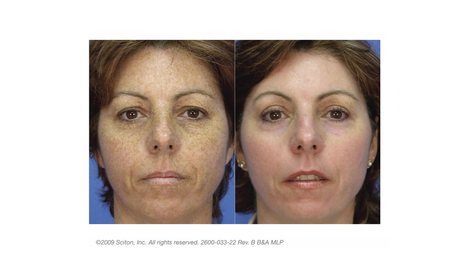 MicroLaser Peel - Everyhting you need to know about it — ici paris skin ...