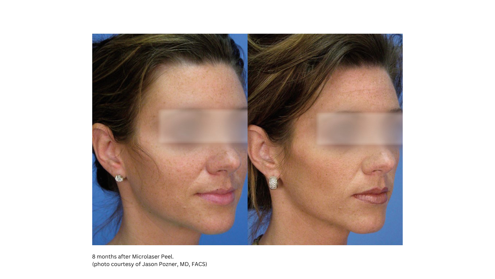 MicroLaser Peel - Everyhting you need to know about it — ici paris skin ...