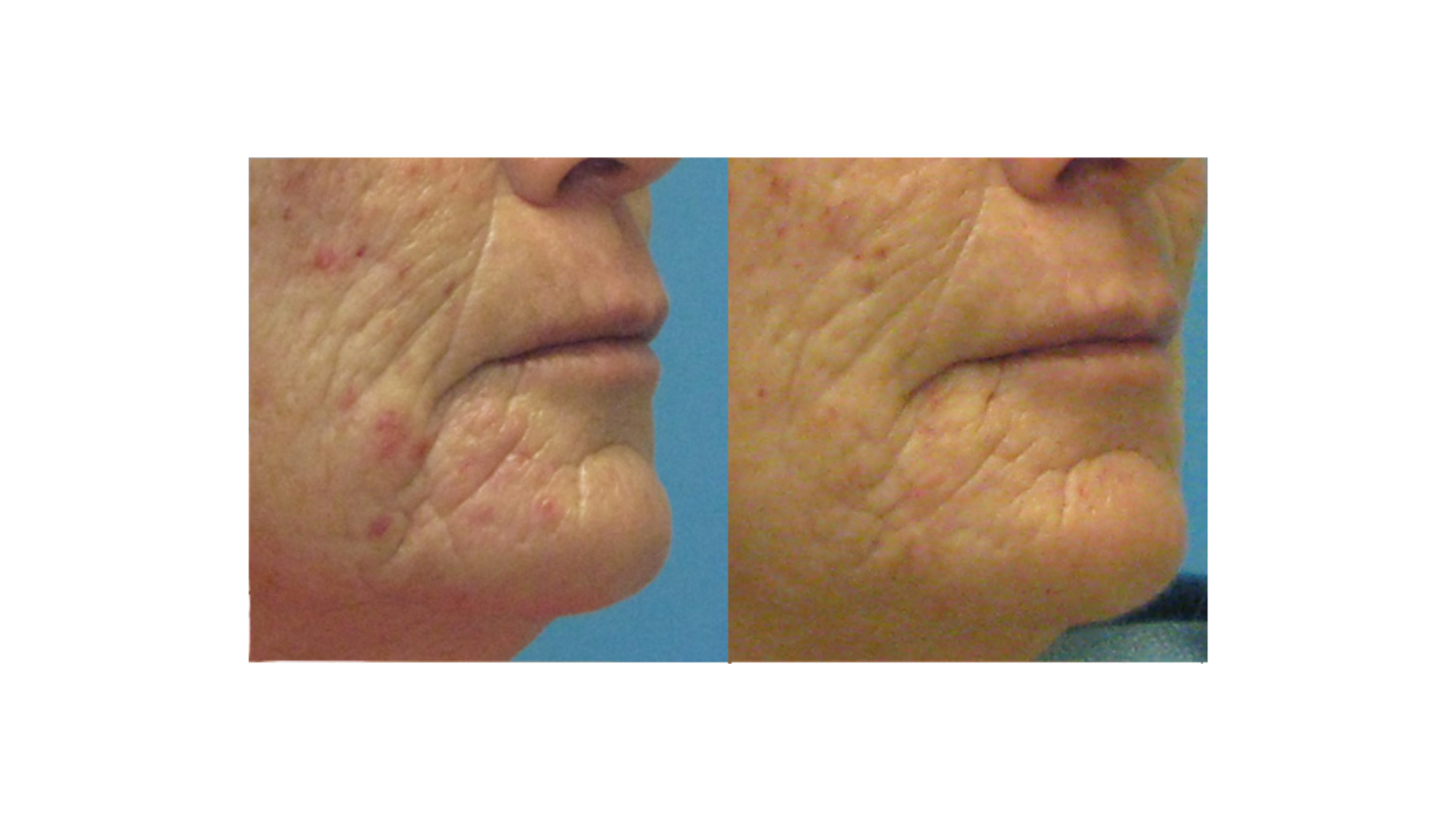 MicroLaser Peel - Everyhting you need to know about it — ici paris skin ...