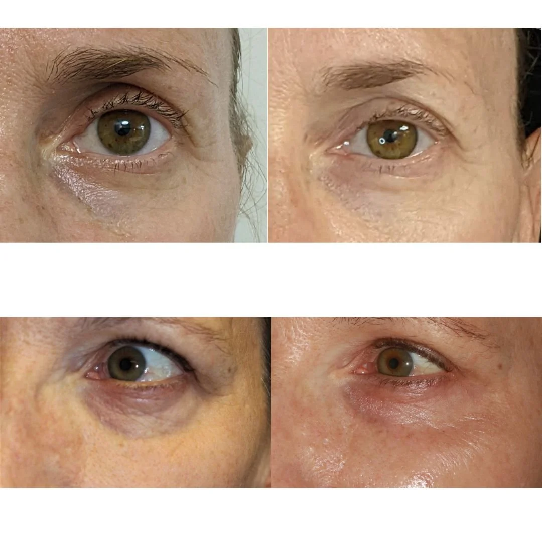 Treatments for Eyes — ici paris skin clinic + spa