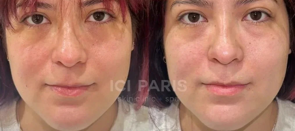 Juvasonic® : A Needleless Skincare Infusion — ici paris skin clinic + spa