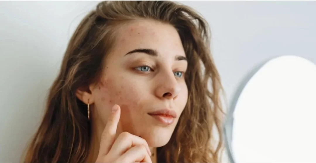 Why your skin might worsen in the spring and how to manage it — ici ...