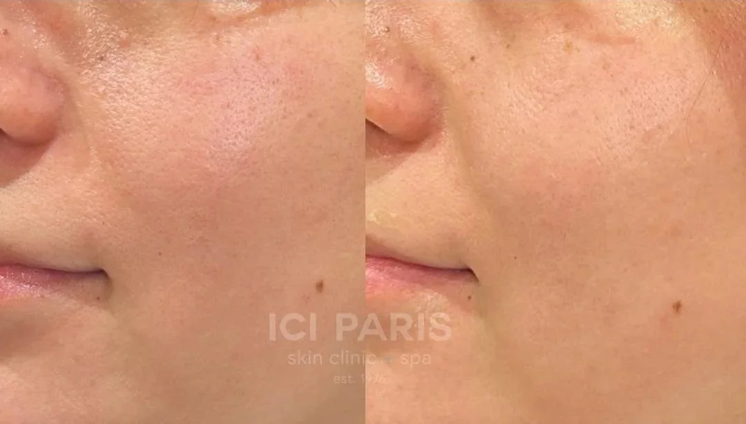 Juvasonic® : A Needleless Skincare Infusion — ici paris skin clinic + spa