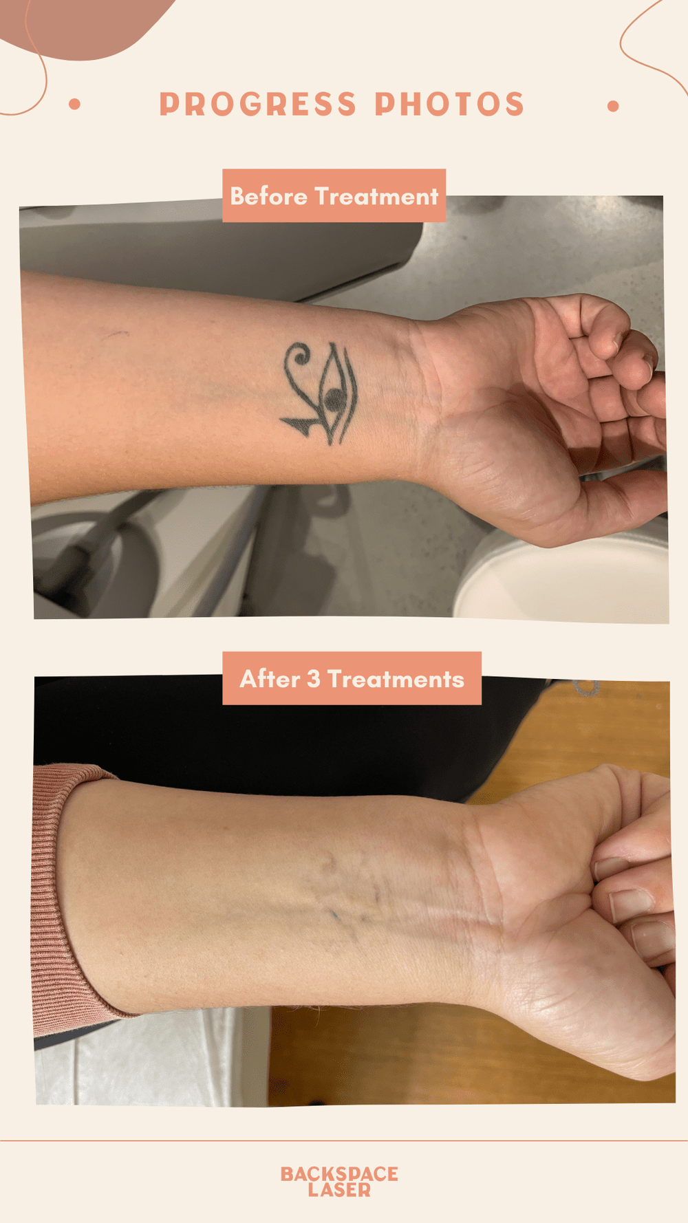Complete Tattoo Removal