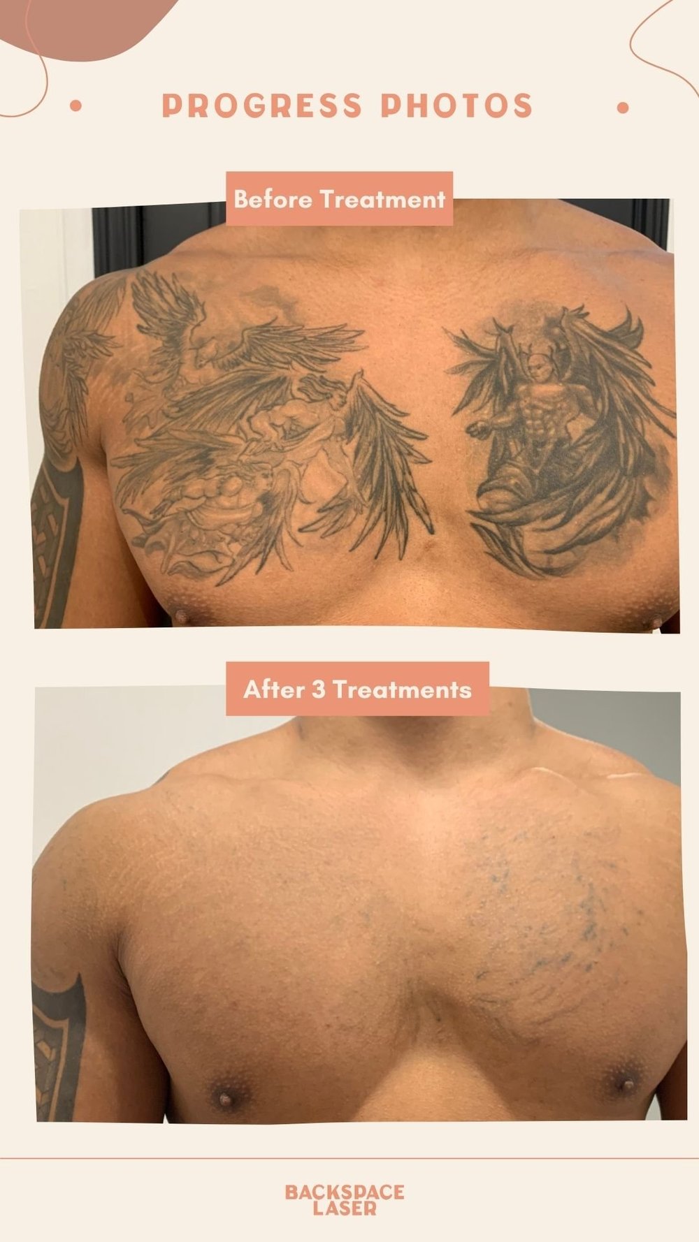 Complete Tattoo Removal