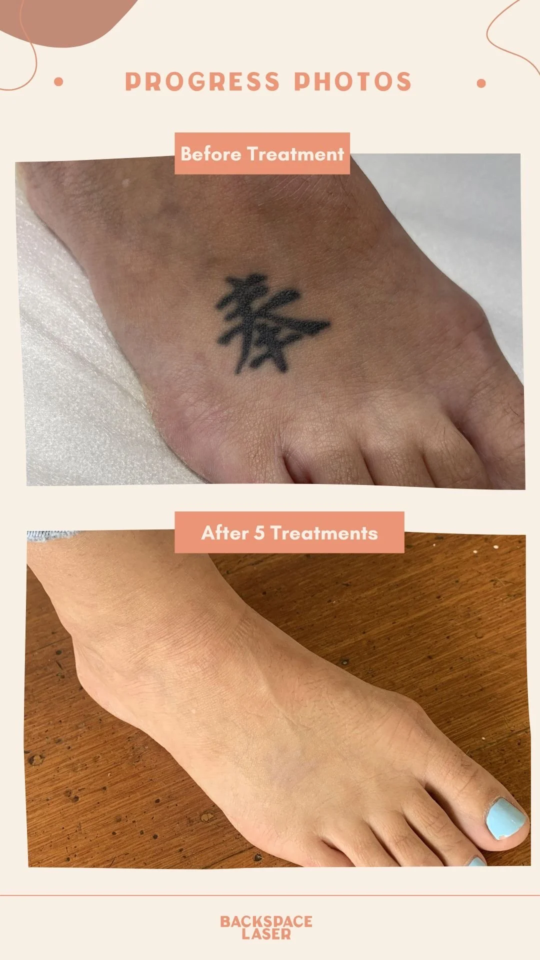 Complete Tattoo Removal