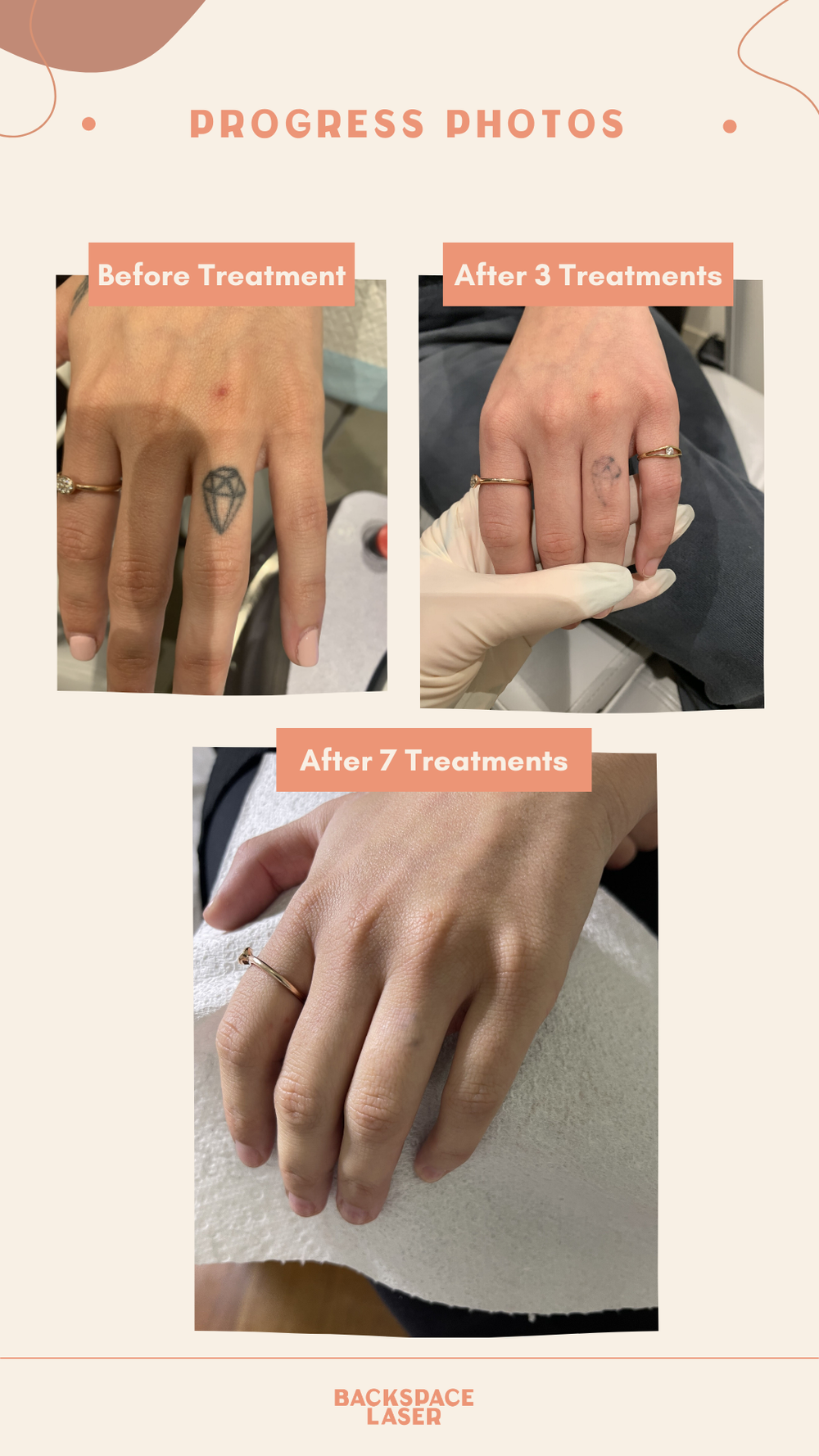 Complete Tattoo Removal