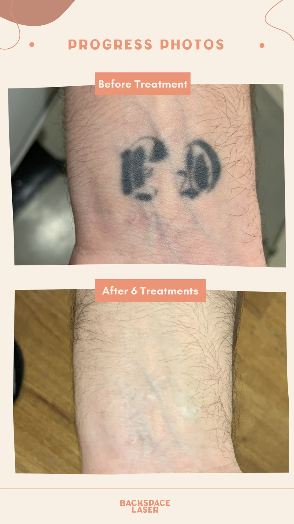 Complete Tattoo Removal