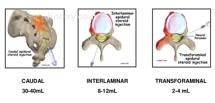 Types Of Steroid Injections: Steroid Injections For Joint Pain – GARAKD