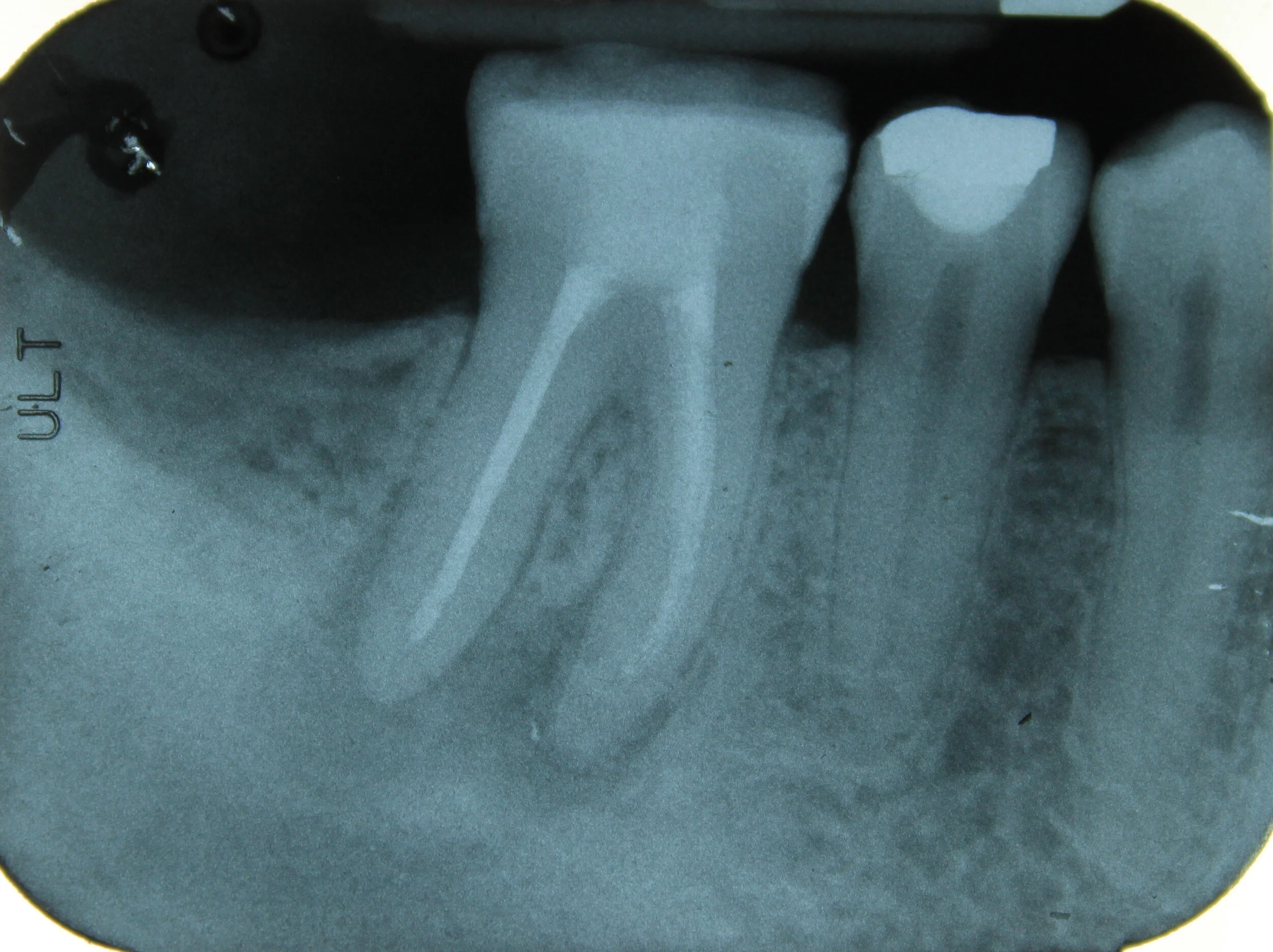 Root canal treated teeth with asymptomatic apical radiolucency: to ...