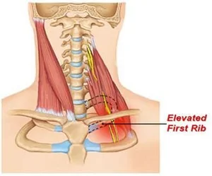 First rib mobilization (video) — EBM Fitness Solutions